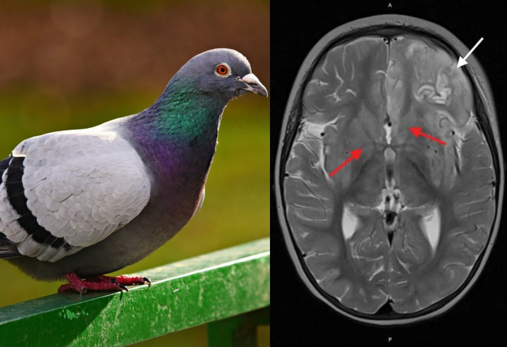 Αυστραλία: Τραγικός θάνατος δίχρονου παιδιού από σπάνιο ιό περιστεριών ...